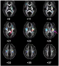 Genetic variants build a smarter brain - The Science - Hayadan