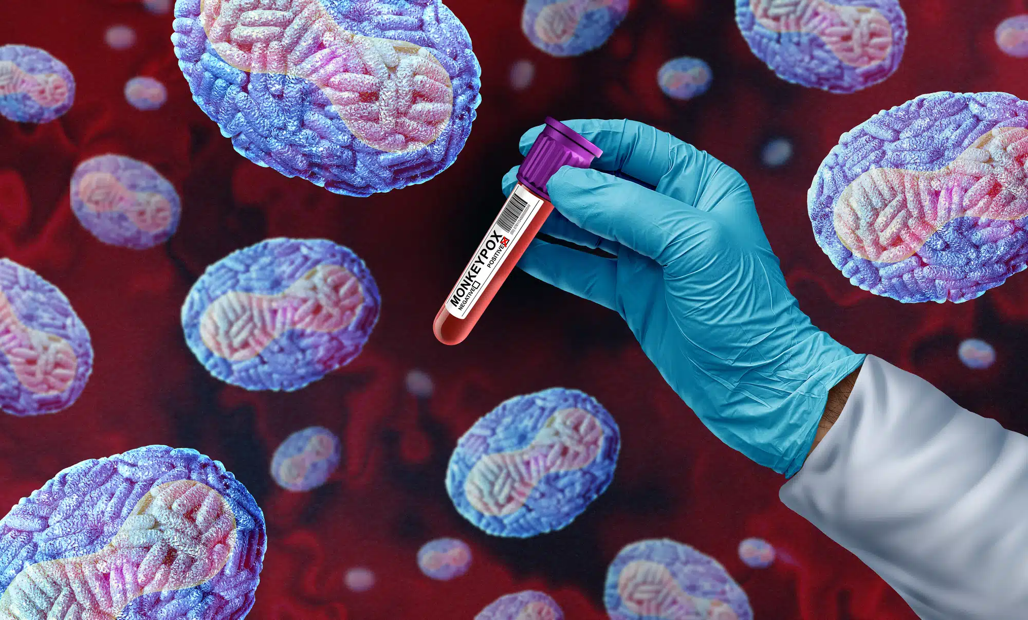 A surge in the incidence of monkeypox in Africa - what must be done to ...